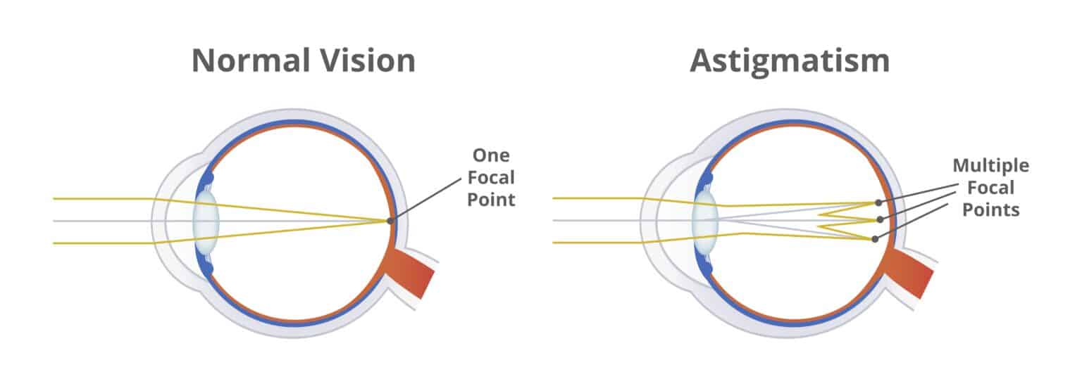Vivity™ Lens: Cataract & Astigmatism Correction