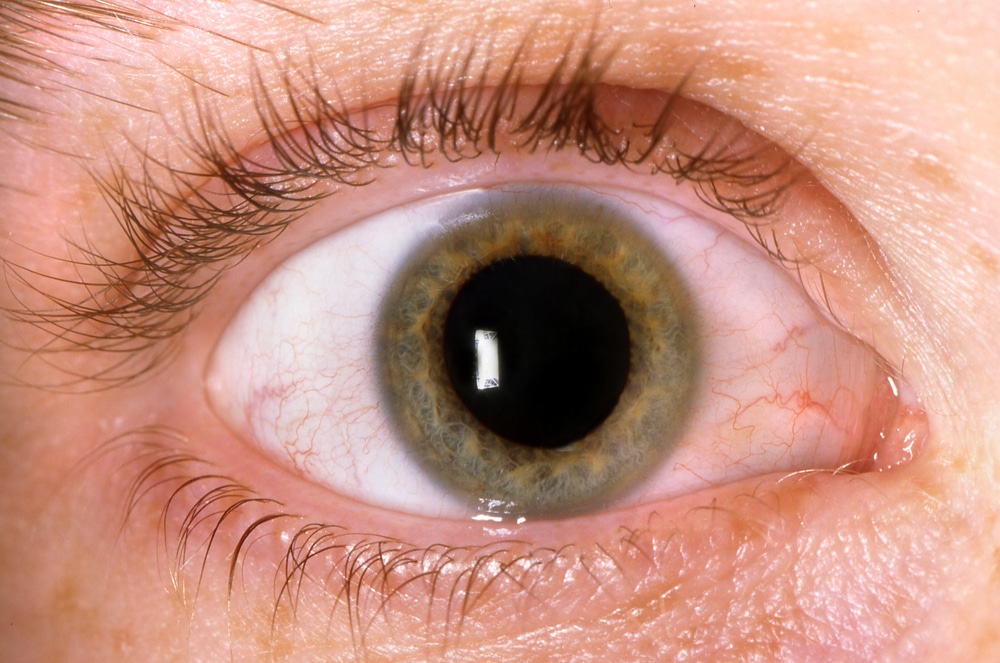 What Causes Dilated Pupils & When To Worry
