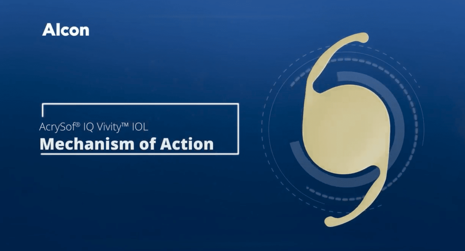 Vivity™ Lens: Cataract & Astigmatism Correction